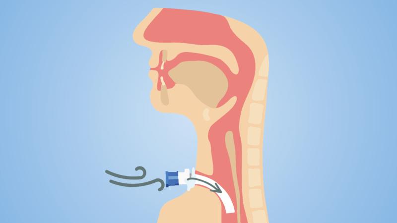 Tracheostoma – Teil 1: Grundlagen | Gru… - smart-aware